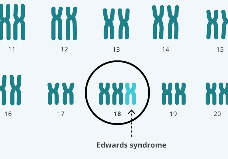 Trisomy 18 | Prenatal Screening Ontario